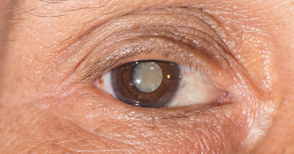 Catarata: sintomas, tratamentos e causas, entenda um pouco mais sobre ...