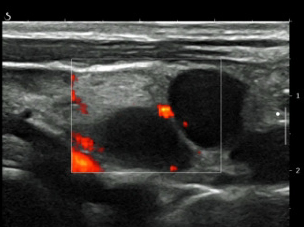 VIETNAMESE MEDIC ULTRASOUND: CASE 575: LYMPH NODE TUBERCULOSIS, Dr PHAN ...