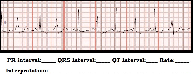 ECG Rhythm Strip Quiz 101: Interval measurements