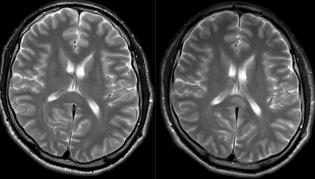 Cytotoxic Lesions Of the Corpus Callosum (CLOCCs)