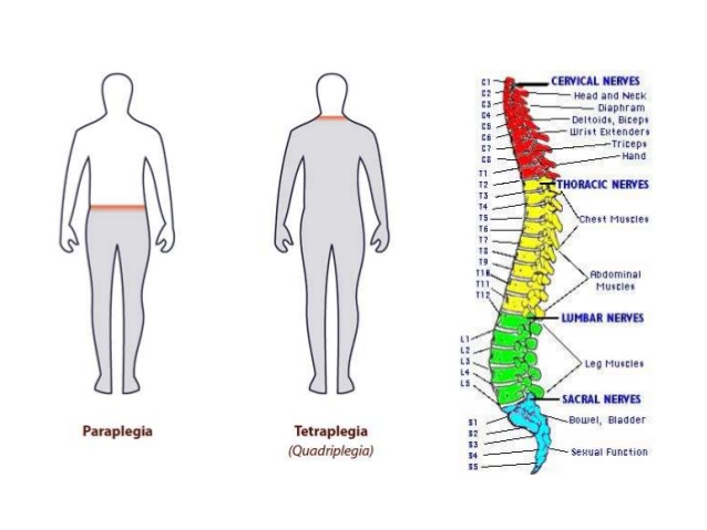 Superação meu desafio: A diferença entre paraplegia e tetraplegia