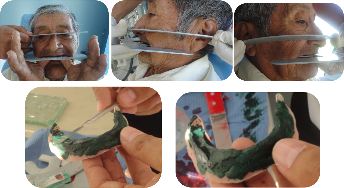 odontologosPerú: Prótesis Total: Zona Neutra