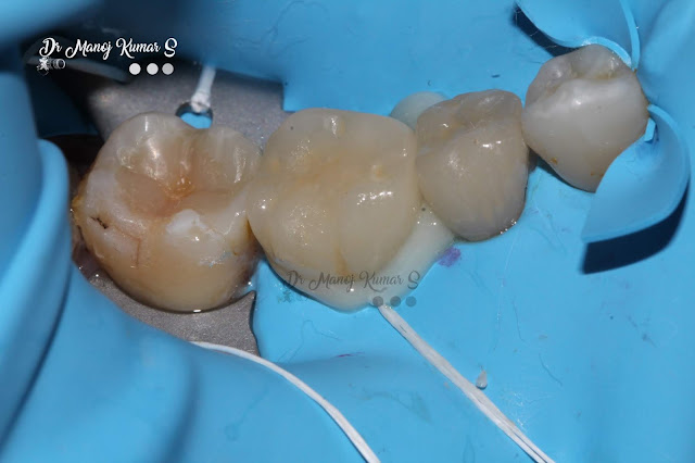 Case 45: Cementation protocol for an emax- lithium disilicate crown
