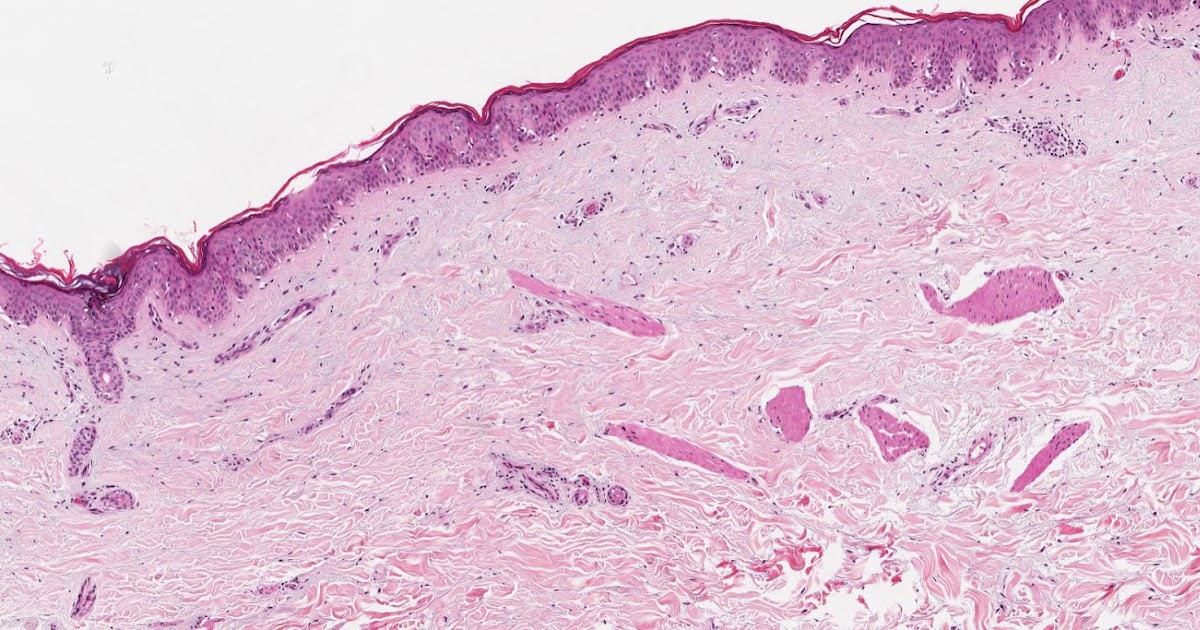 Differential Diagnosis in Dermatopathology: Blue staining