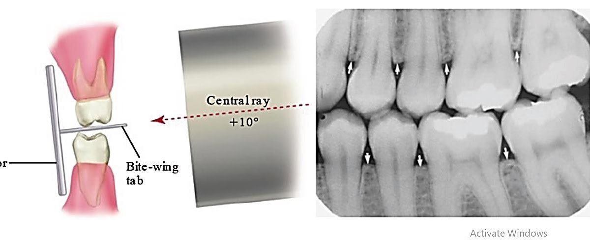 Bitewing technique l Oral radiology MCQs - WikiDentia
