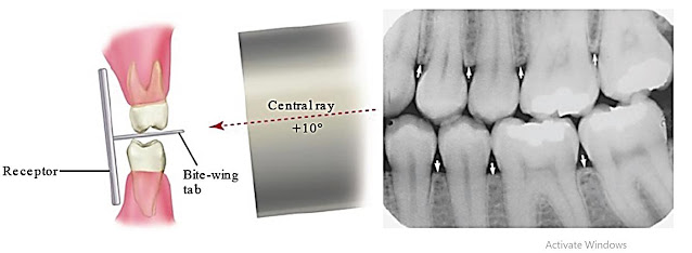 Bitewing technique l Oral radiology MCQs - WikiDentia