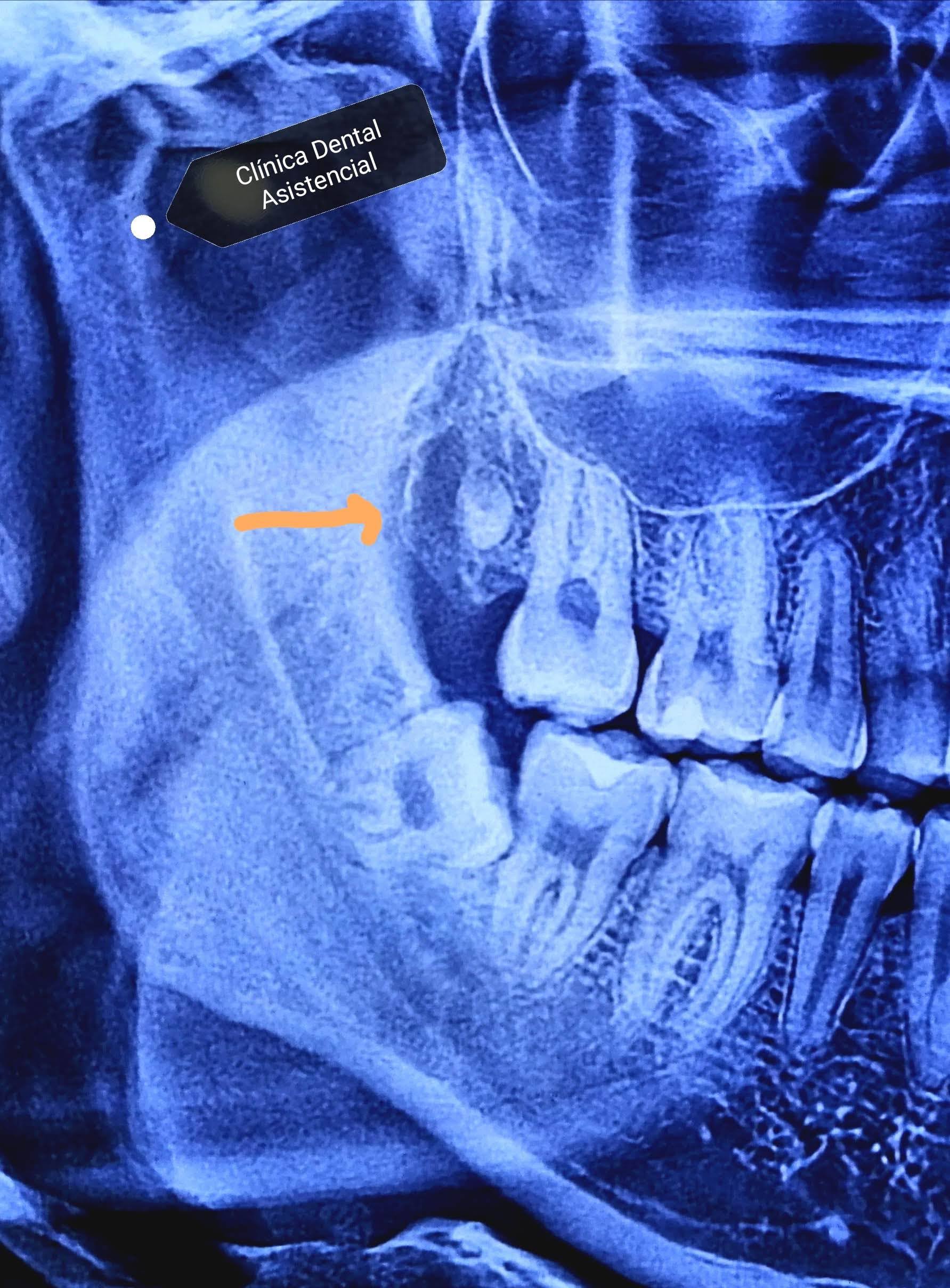 CLINICA DENTAL ASISTENCIAL: MICRODONCIA