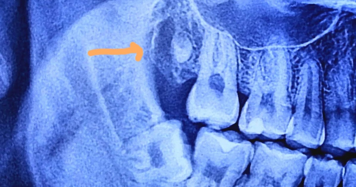 CLINICA DENTAL ASISTENCIAL: MICRODONCIA
