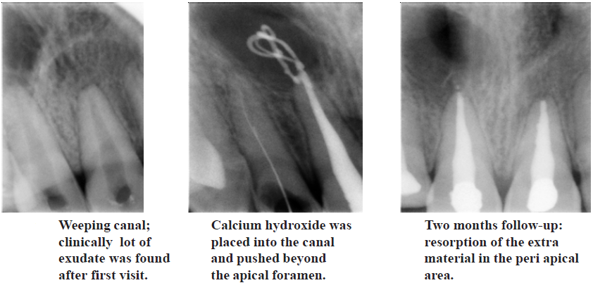 When to Obturate the Canal - Endodontics and Oral Implantology