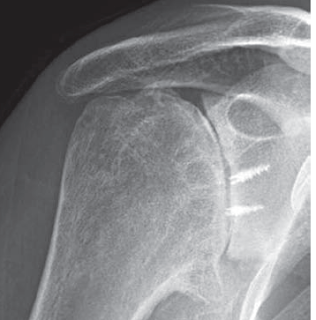 UW Shoulder and Elbow Academy: Humeral head osteotomy in shoulder ...