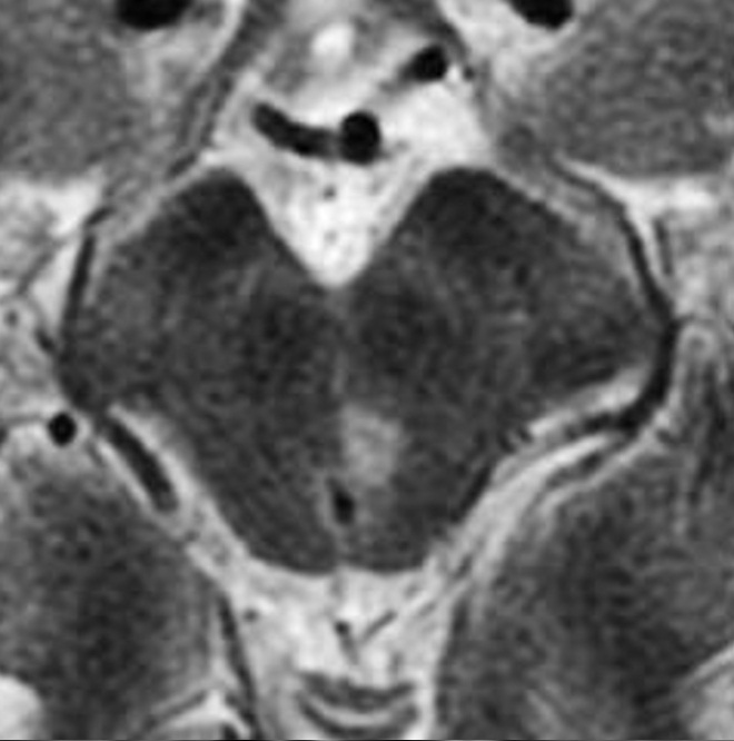 Dr Balaji Anvekar FRCR: Vascular territories of Brain stem and Infarct ...