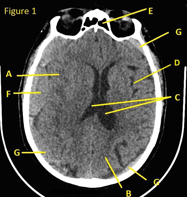 Cas Clinique 1 : Traumatisme crânien - Cas Imagerie