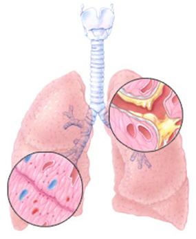 Etiologi Bronchitis