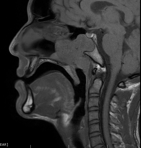 Nasopharyngeal Angiofibroma-MRI - Sumer's Radiology Blog