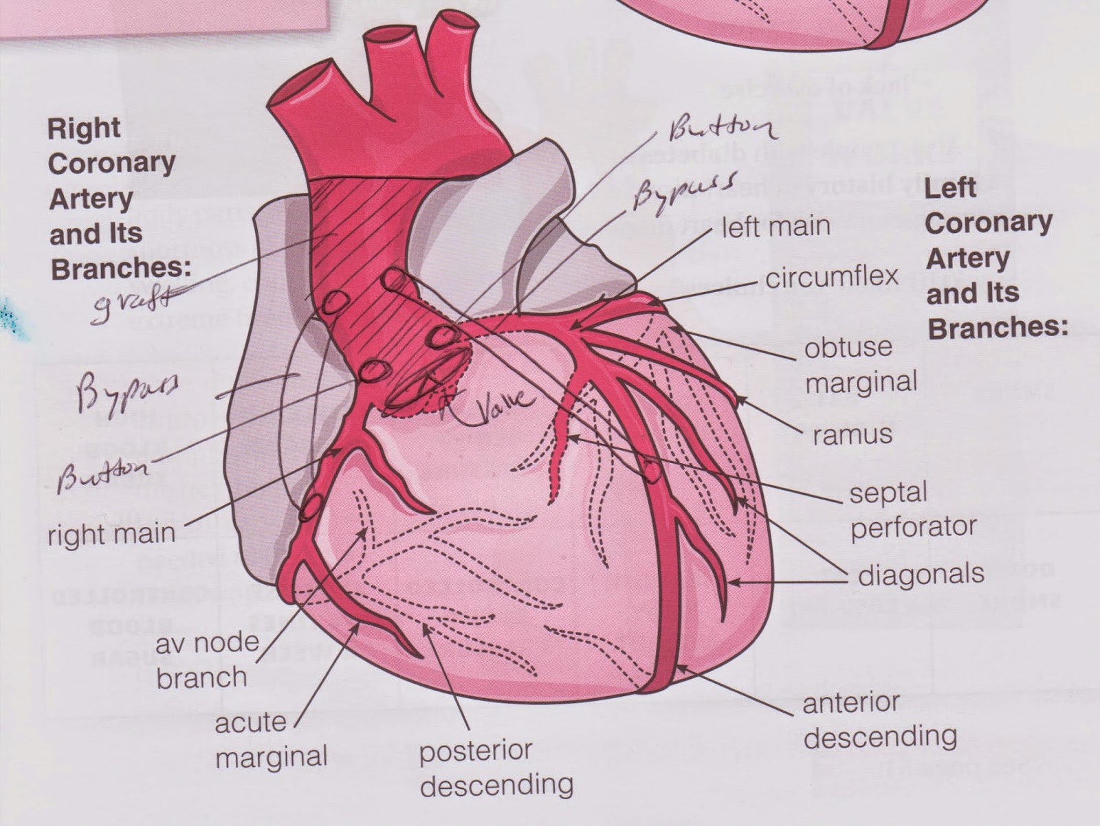 Jim's Bicuspid Heart Valve Diary: Illustration: Surgeon Draws Diagram ...