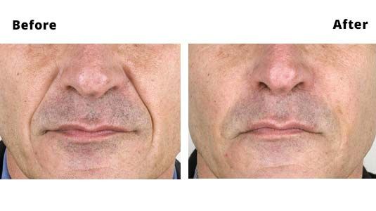 Selston Cosmetic Clinic: Ease Nasolabial Grooves With Dermal Filler ...