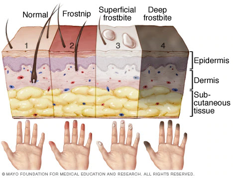 Tips and Knowledge: What is Frostbite?
