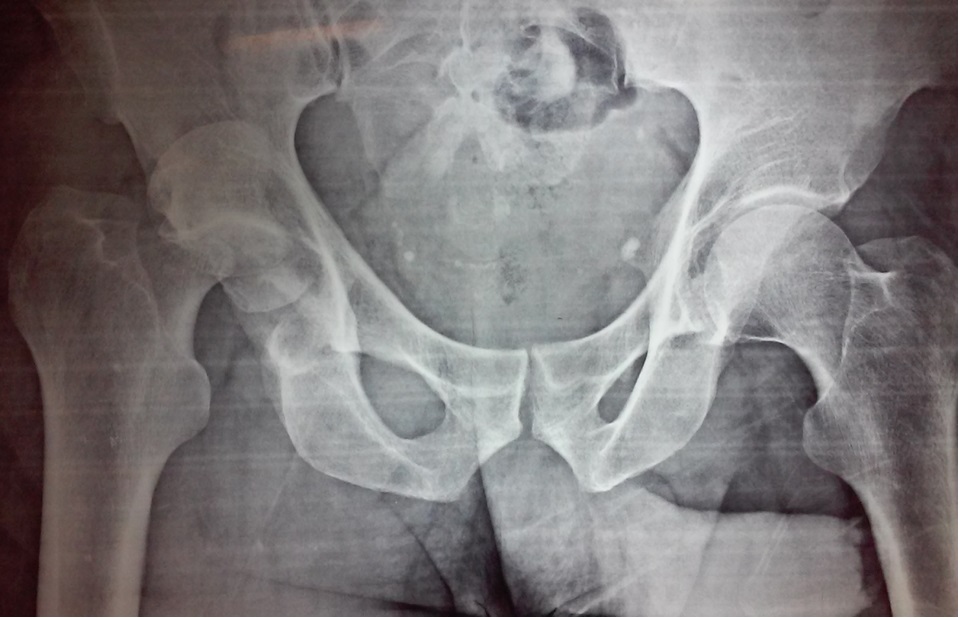 O R T O C R I T I C A: FRACTURA LUXACIÓN DE CADERA