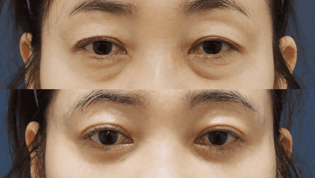 [JW Bedah Plastik Korea] Sub Brow lifting atau forehead lifting