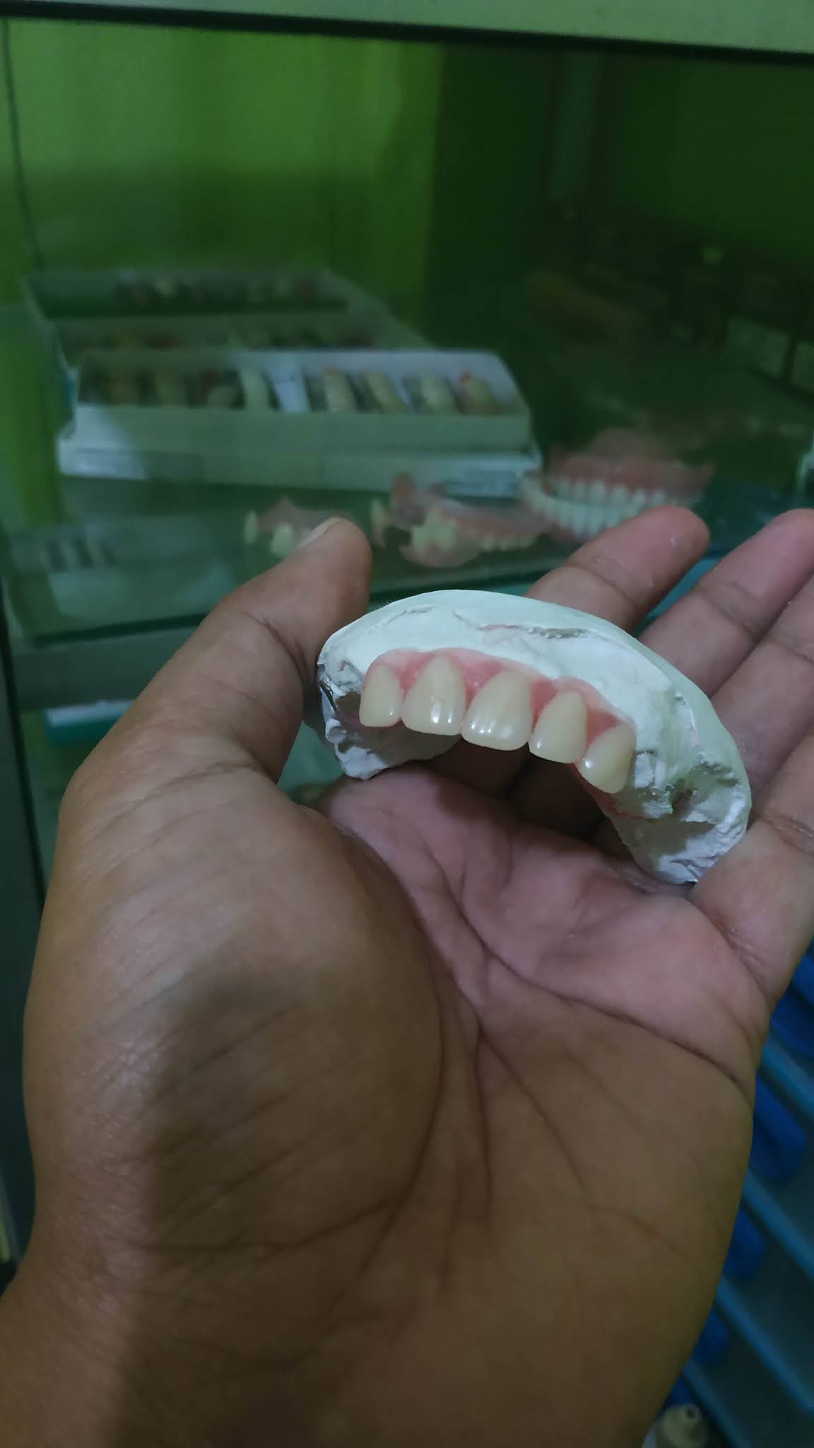 AHLI GIGI PURWOKERTO PURBALINGGA: Bagaimana pemasangan gigi palsu yang ...