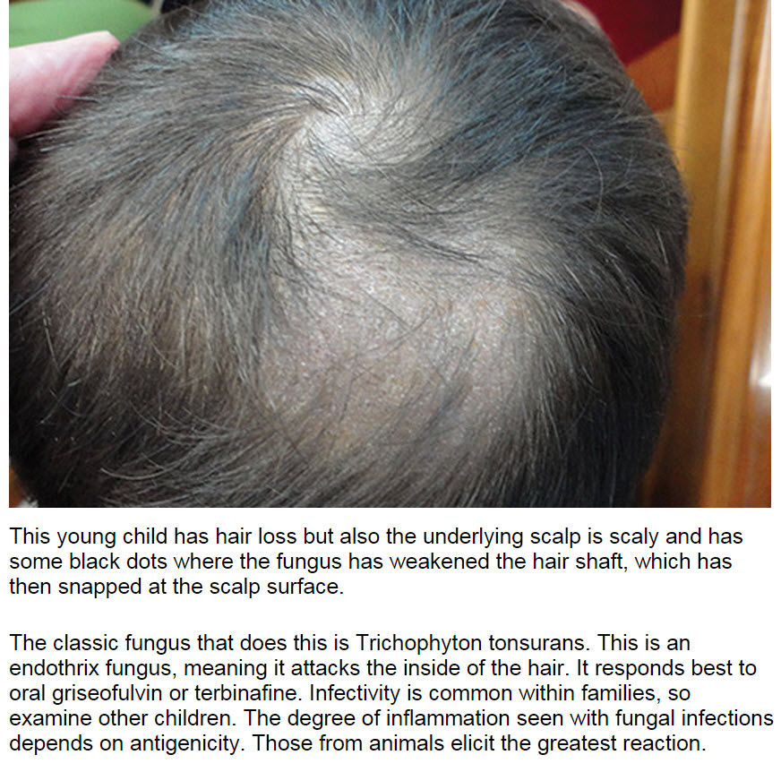 Consultations in Dermatology: Tinea capitis