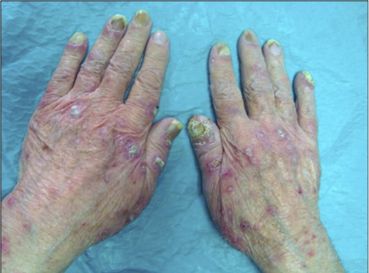 Enfermedades Raras, ¿y eso de qué va?: SÍNDROME DE BAZEX