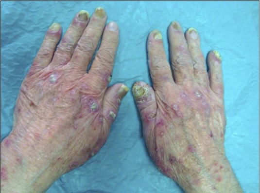 Enfermedades Raras, ¿y eso de qué va?: SÍNDROME DE BAZEX