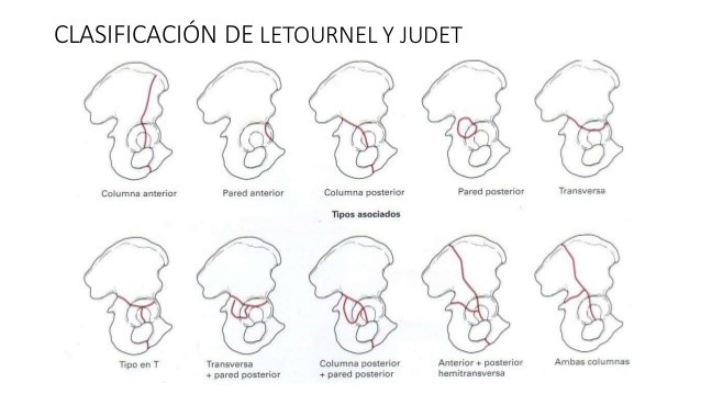 Fracturas de Cadera y Pelvis
