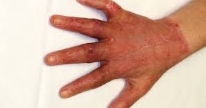 Principles of Physiotherapy for Burn Cases