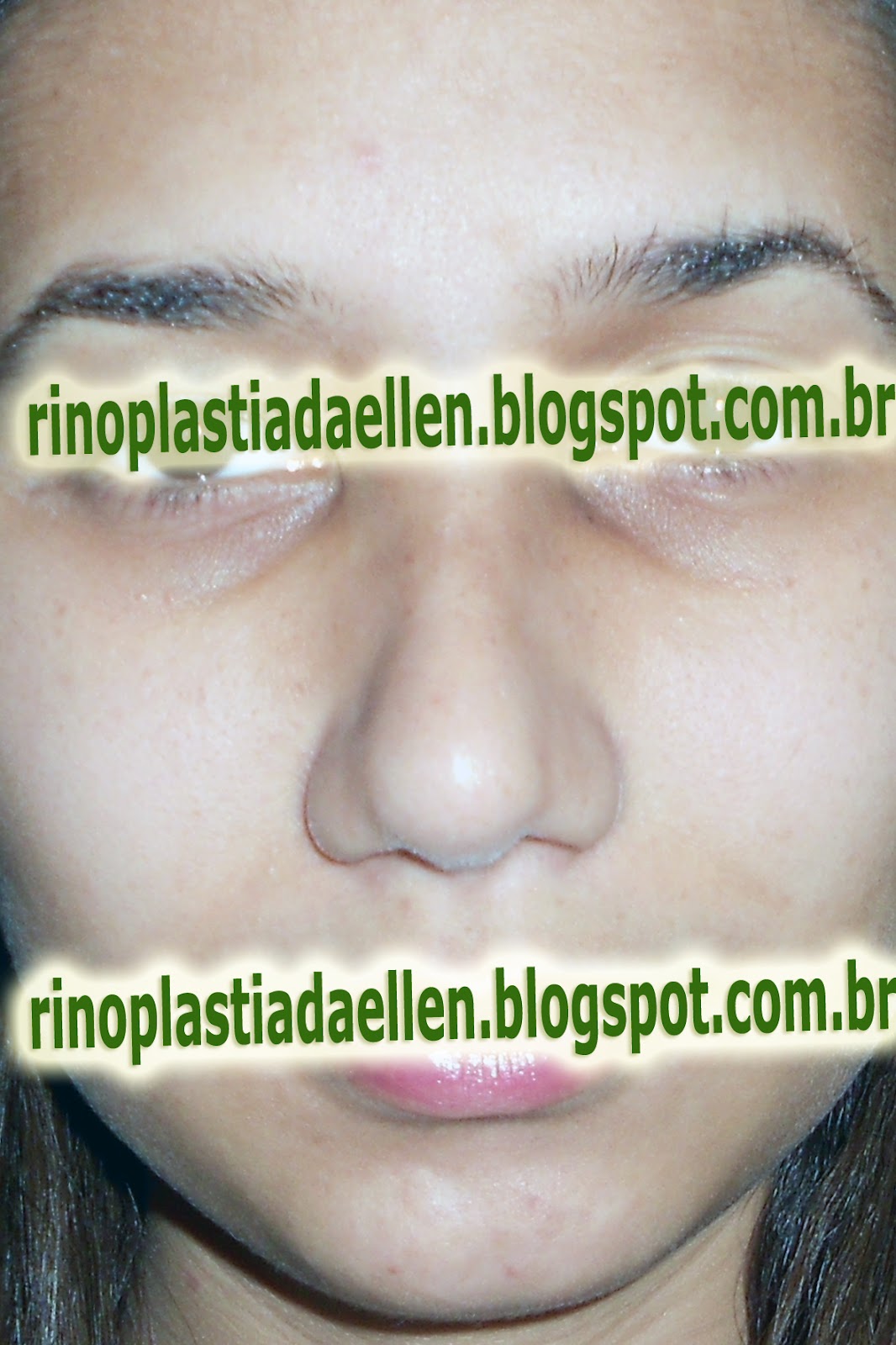Rinoplastia da Ellen , Rhinoplasty, Nasenkorrektur, nose job