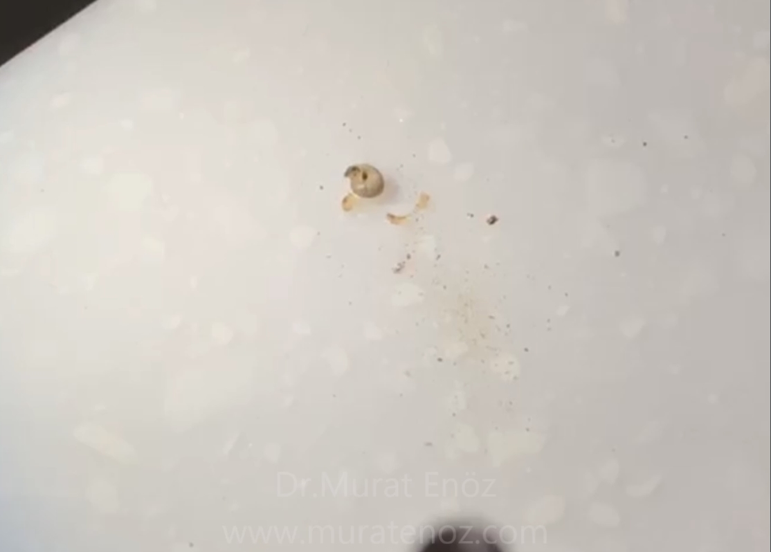 Unusual Foreign Body in The Ear Canal: Sea Snail