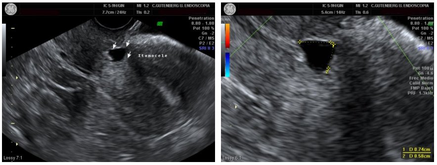 Endoscopia Ginecologica