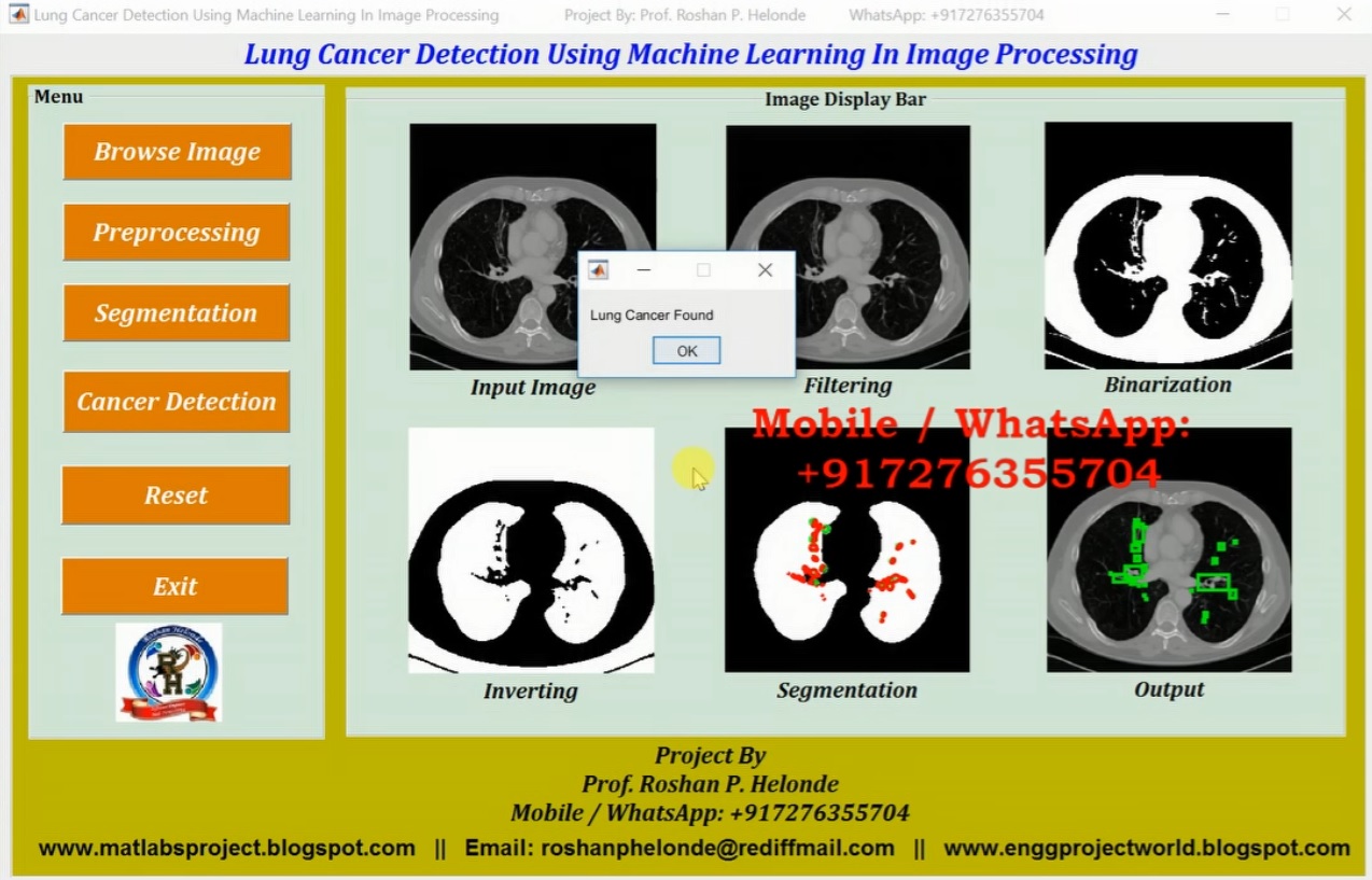 Lung Cancer Detection Using Machine Learning Technique Matlab Project Source Code ~ Engineering