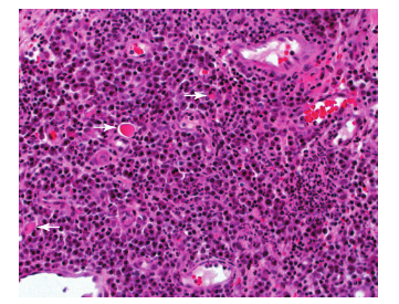 Apa Itu Pododermatitis?