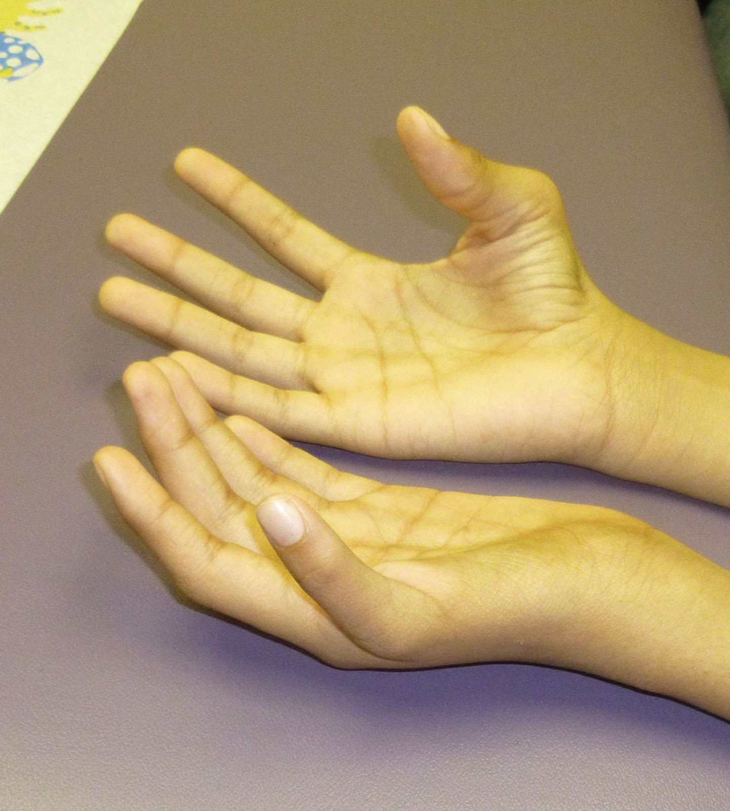 Small thumbs | Congenital Hand and Arm Differences | Washington ...