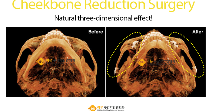 Considering cheekbone reduction surgery _ EU