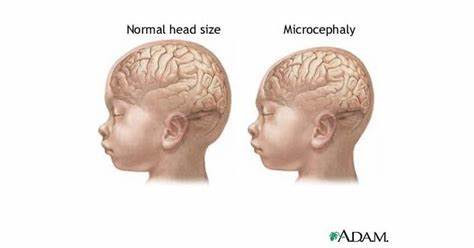 Mind Science: What is Microcephaly