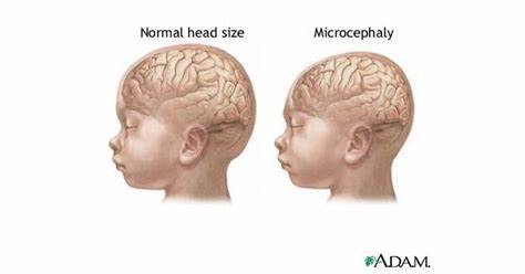 Mind Science: What is Microcephaly