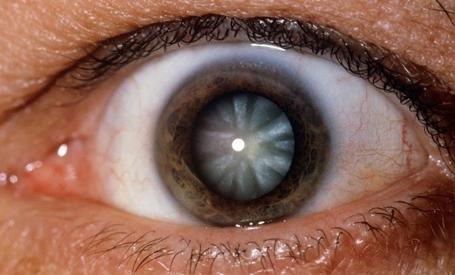 Cataract, It's causes, treatment and Cataract Surgery - Eye Health Nepal