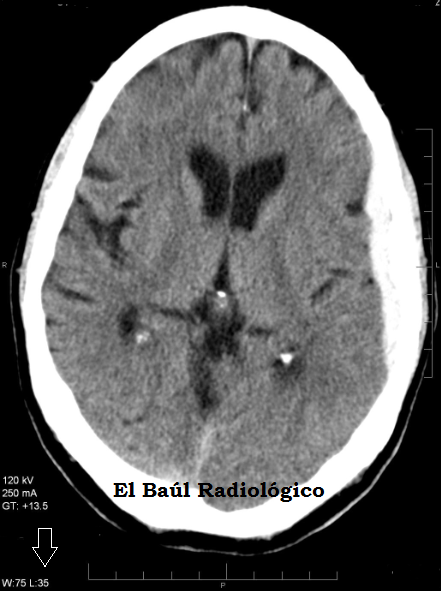 El Baúl Radiológico: NIVEL Y AMPLITUD DE VENTANA EN TOMOGRAFÍA ...