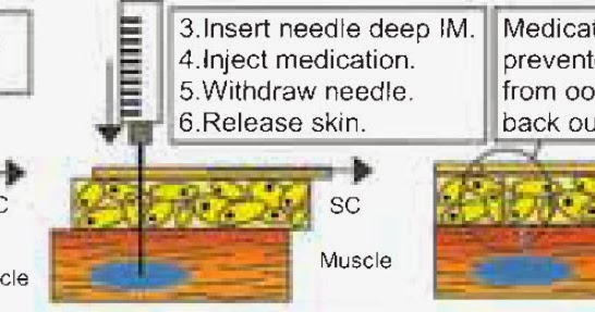Z-Track Method for Giving IM Injections ~ Nursing