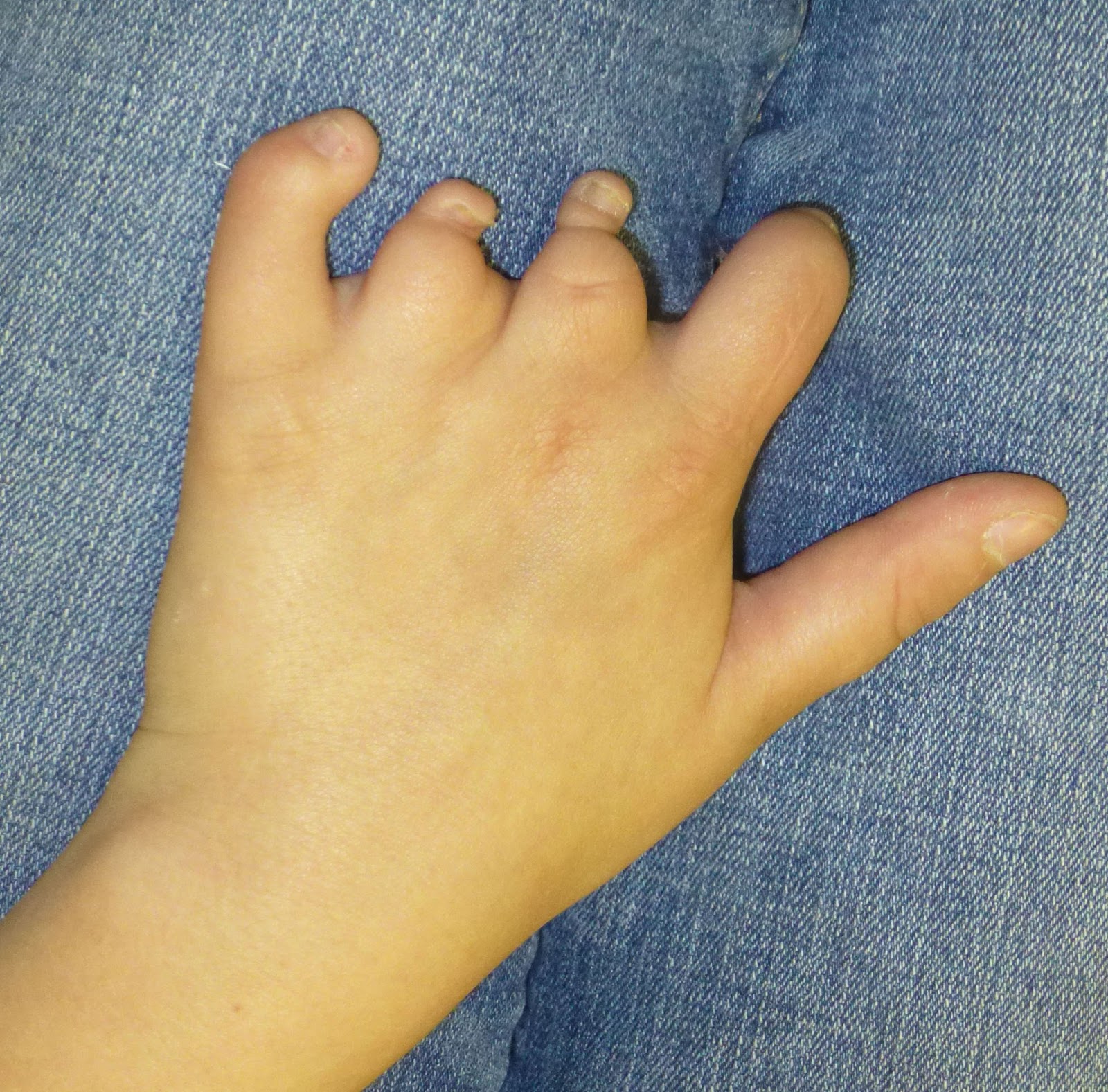 Toe Transfers | Congenital Hand and Arm Differences | Washington ...