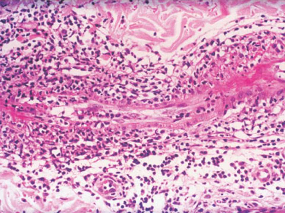 PATHOLOGIST WORLD by Dr. Juan J. Barcia: Vasculitis