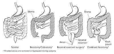 Seeking Healthy Life: What is an Ileostomy Surgery? – Types of an Ileostomy