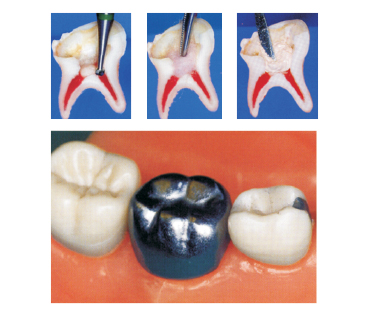 Odontopediatria "PULPOTOMIA": 2016