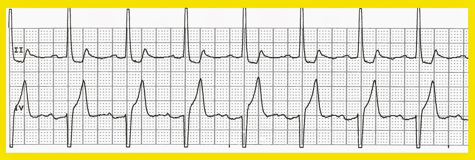 Various Normal Sinus Rhythms