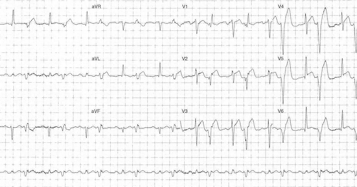 ECG of the Week: ECG of the Week - 1st February 2016 - Interpretation