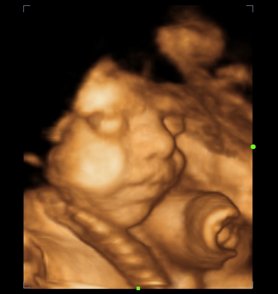 BANGALORE ULTRASOUND BLOG: 3D/4D scan for pregnancy