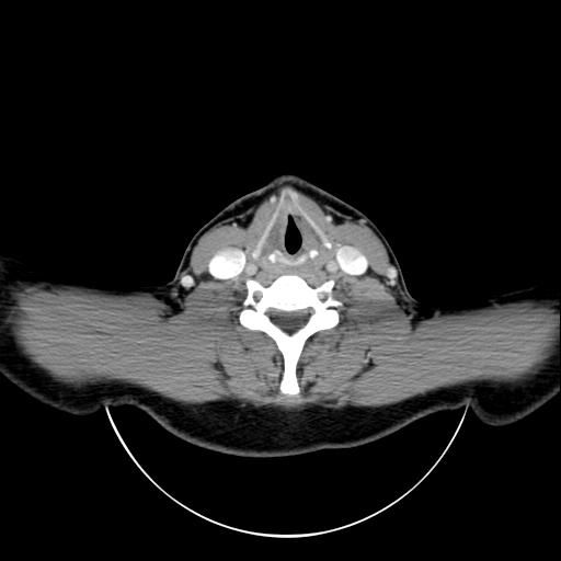 UNIDAD DE VOZ HOSPITAL DE PONIENTE: TUBERCULOSIS LARINGEA