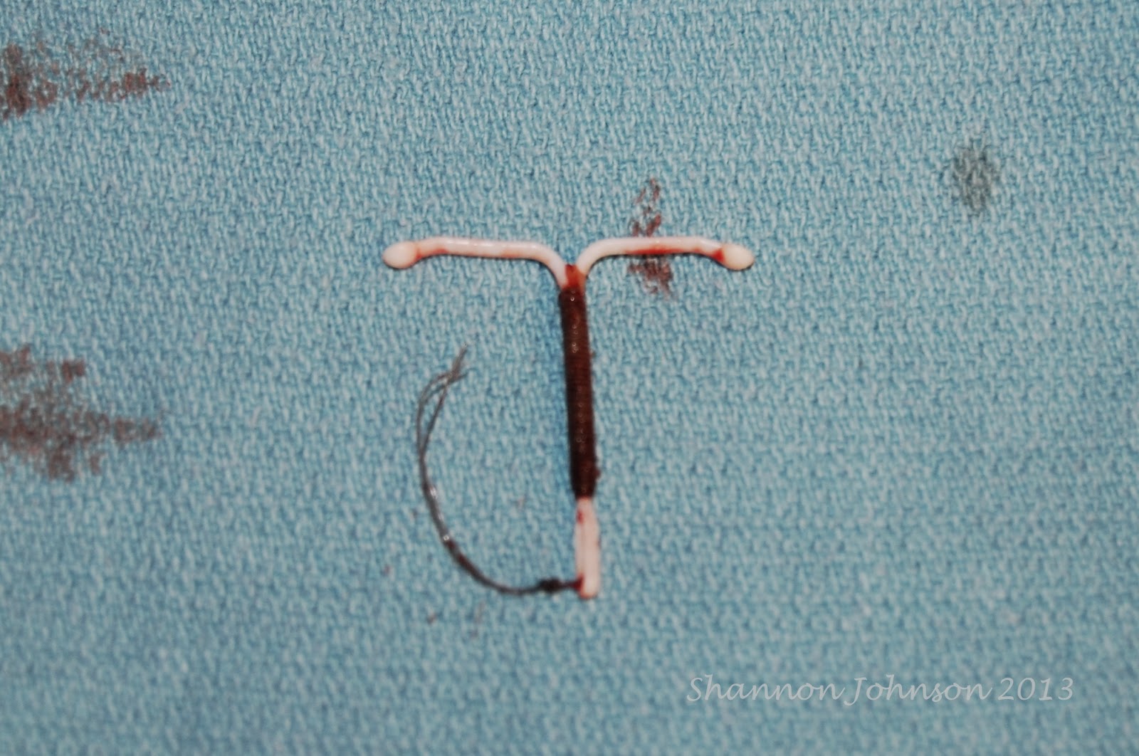My IUD Pregnancy